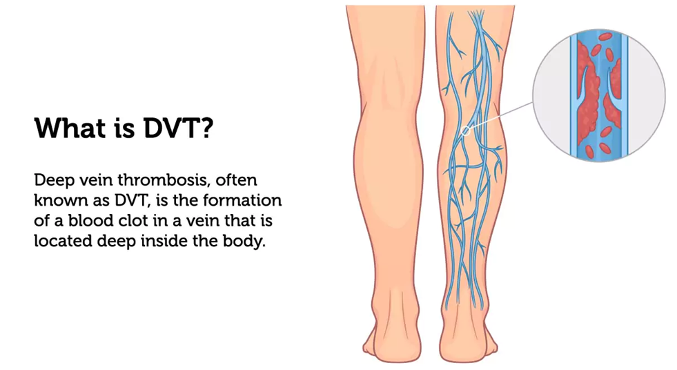 Deep Vein Thrombosis forms in a deep vein UPSC