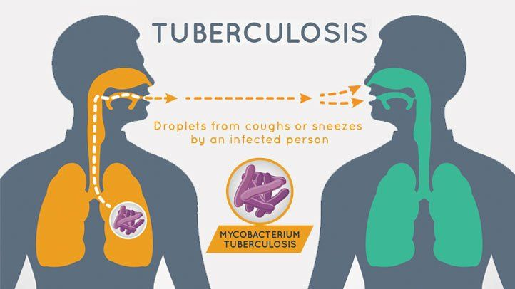 TB report 2024 shows progress in India's TB fight UPSC