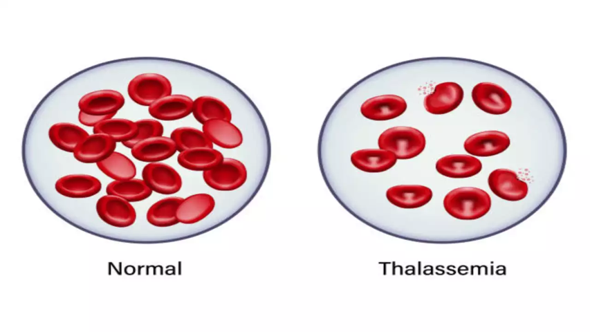 International Thalassemia Day UPSC