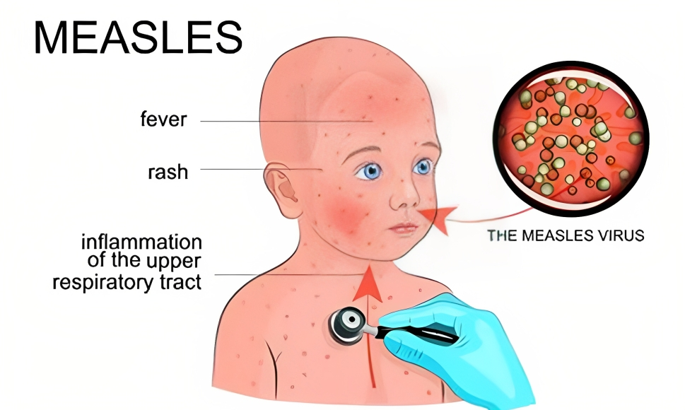 Large-scale Measles outbreak in London -IAS GYAN