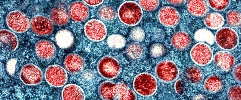 Mpox: Understanding the Virus and Its Impact | Poxvirus UPSC