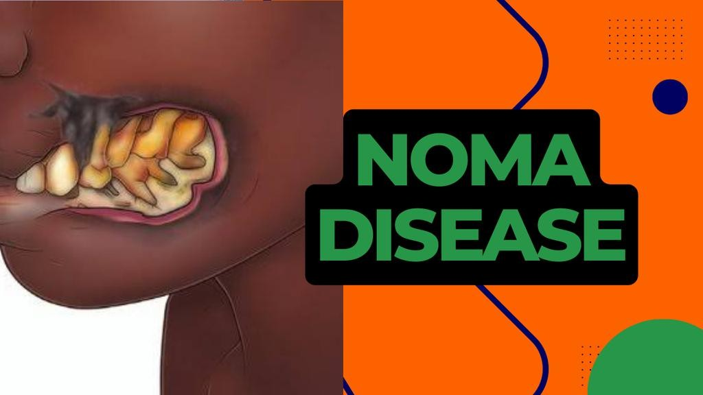 WHO adds noma to neglected tropical diseases UPSC