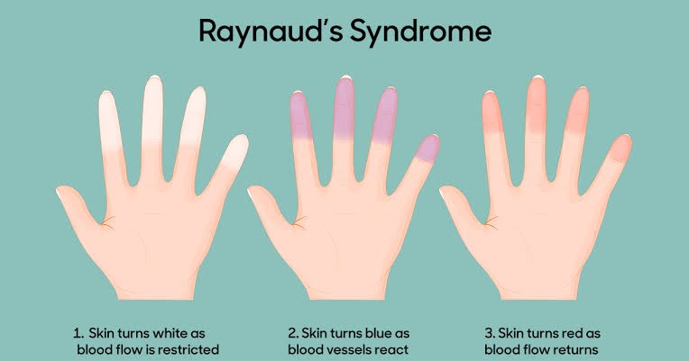 Raynaud’s Phenomenon UPSC