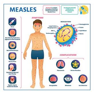 Measles | IAS GYAN